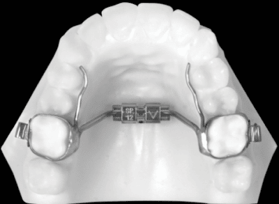 Hyrax – Appareil d’expansion rapide – KD1 Cabinet de Pédodontie & d ...