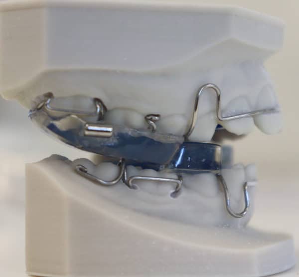 TwinBlock : Appareil fonctionnel amovible – KD1 Cabinet de Pédodontie ...